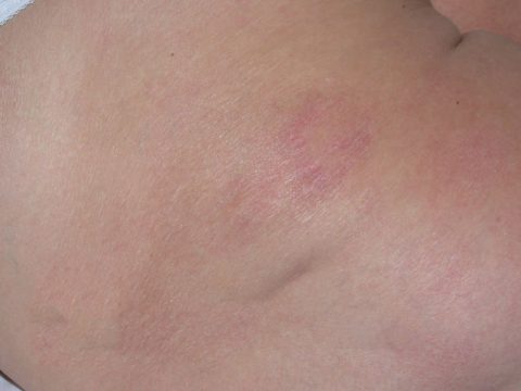 Mycosis Fungoides - Dermatologist consultation online- iDerma